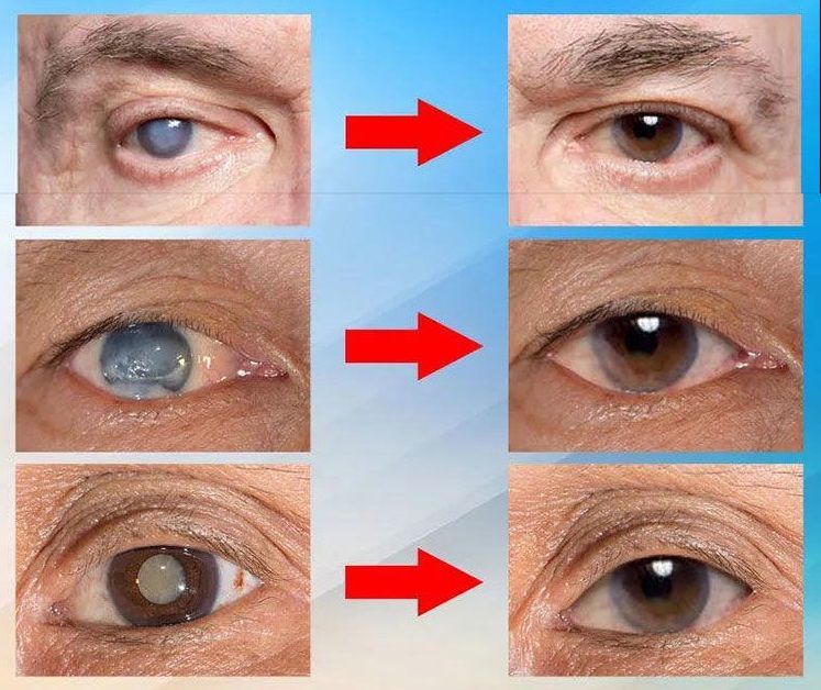 Japan Vision Drops — Rapidly Heals All Eye Conditions & Restores Visio ...